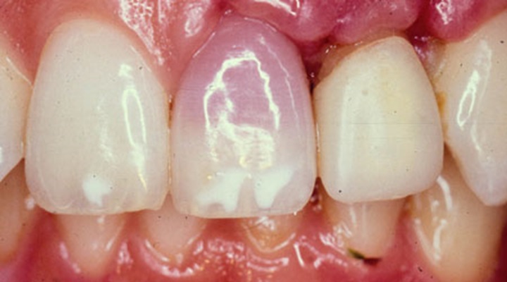 Pictures of Common Dental Problems | MouthHealthy - Oral Health ...