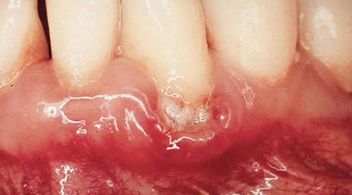 Pictures of Common Dental Problems | MouthHealthy - Oral Health ...