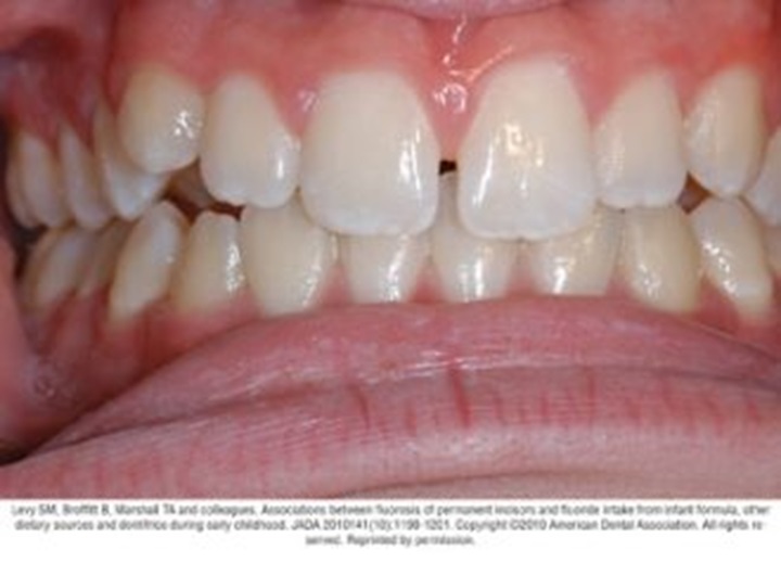 Fluorosis | MouthHealthy - Oral Health Information from the ADA