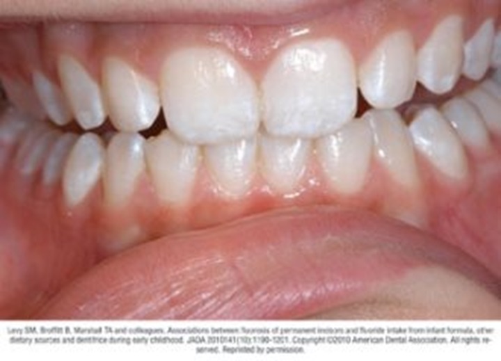 Fluorosis | MouthHealthy - Oral Health Information from the ADA